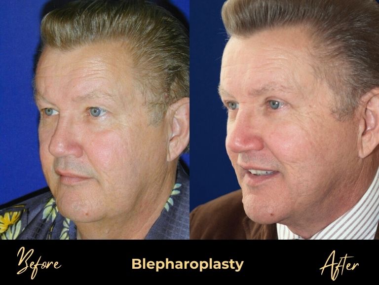 The Guy's Guide to Getting Rid of Man Boobs - Blackhawk Plastic Surgery ...